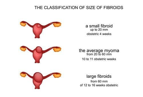All You Need to Know About Fibroids | SMG Women's Health